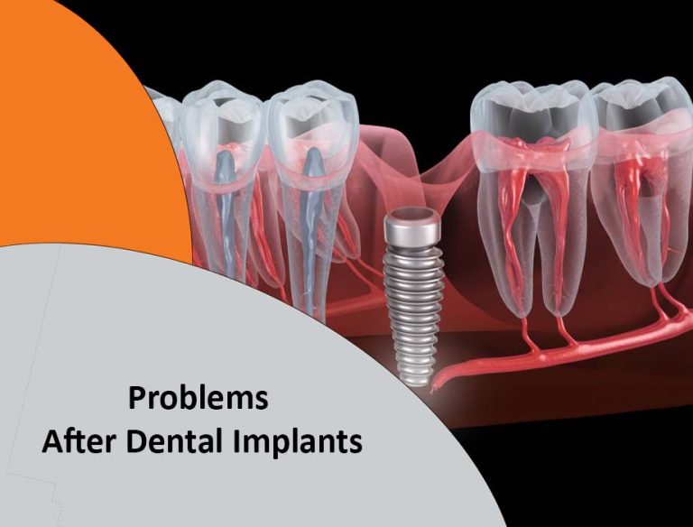 7 Common Problems After Dental Implants